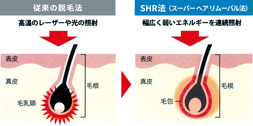 美肌脱毛 | 脱毛＆痩身＆水素サロン/花小金井・小平【Smooth lab/スムースラボ】